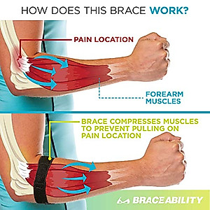 BraceAbility Epicondylitis Brace | Elbow Strap for Medial / Lateral Epicondyle Pain and Tendonitis Arm Compression Support Band for Men or Women (One Size Fits Most)