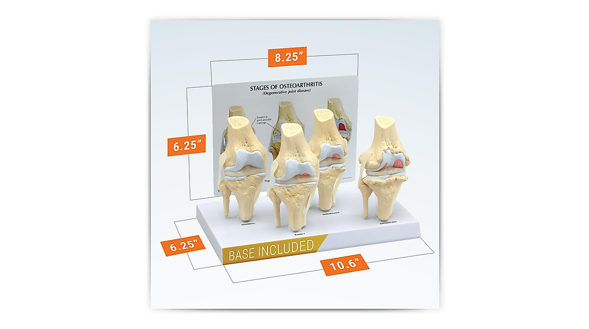 GPI Anatomicals Knee Joint Model Set - Osteoarthritis Anatomy Tools