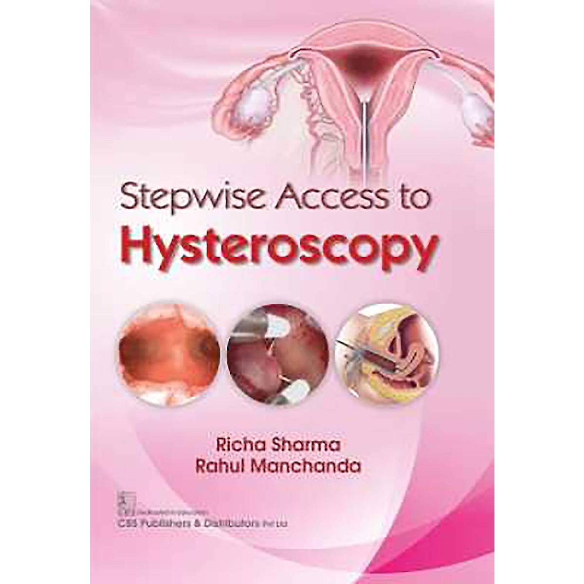 Stepwise Access to Hysteroscopy