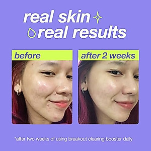 Dermalogica Clear Start Breakout Clearing Booster (1 Fl Oz) Acne Spot Treatment with Salicylic Acid - Clears Breakouts & Locks in Moisture To Soothe Irritation