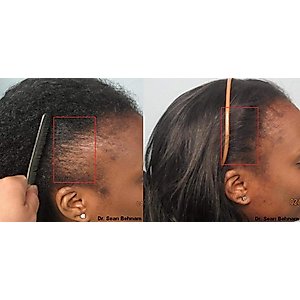 Black Seed Oil for powerful Hair growth - Thick and Full