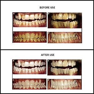 N Noble One Teeth Whitening Device with LED Red Lights Therapy, 32 LED Teeth Whitening Light, Enhancer Light Trays, 16 Minute Timer (White)