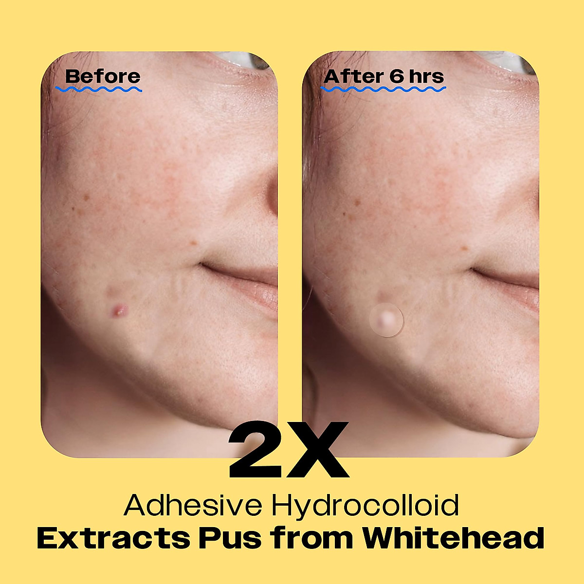 AVARELLE Invisible Acne Spot Patch (24 Count) Ultra Thin Hydrocolloid Spot Sticker for Day Time Acne l For Covering Zits & Blemish with Calendula, Rosehip Seed, Vegan, Cruelty Free