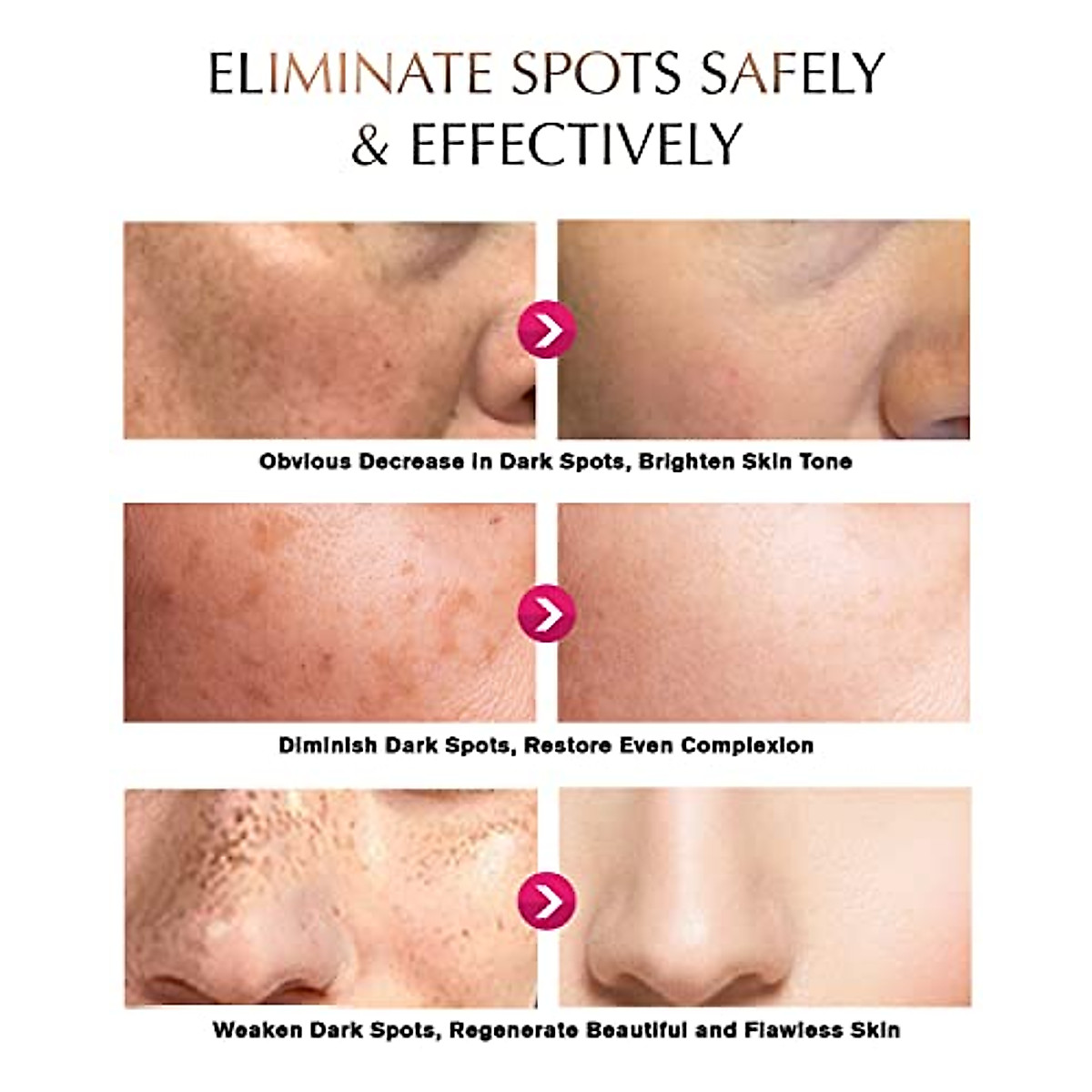 EnaSkin Professional Dark Spot Remover for Face and Body, Perfecting Dark Spot Corrector Serum Treatment, Melasma, Freckle, Sun Spot, Hyperpigmentation, Blemish Spot, Brown Spots for Men&Women, Advanced Formula with Safe Ingredients 4-Butylresorcinol, Koj