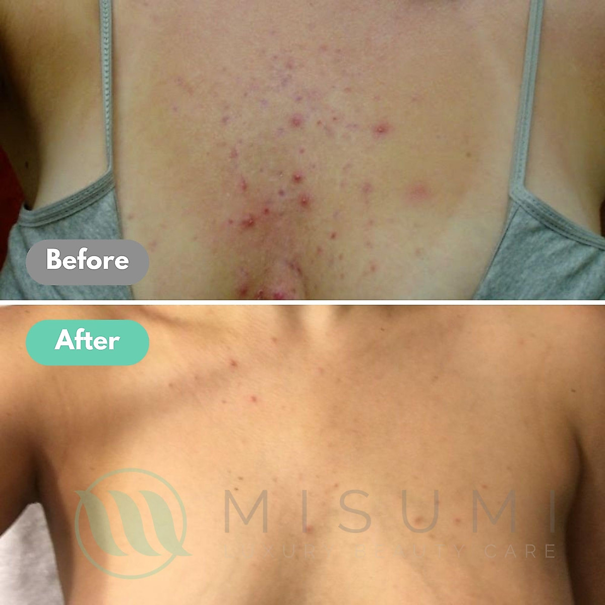 Misumi Acne Body Wash 120ml (4oz) - Keratosis Pilaris Treatment, Body & Back Acne Treatment - Salicylic Acid, Glycolic Acid AHA Body Wash for Men & Women Bacne