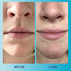 Kinship Supermelt Lip Smoothing Jelly Mask - Moisturizing Daily Lip Treatment + Hyaluronic Acid - Hydrating + Exfoliating Lip Gloss - Soft + Plump - Quick Melting Balm - Soothe Dry Lips (.3 oz)