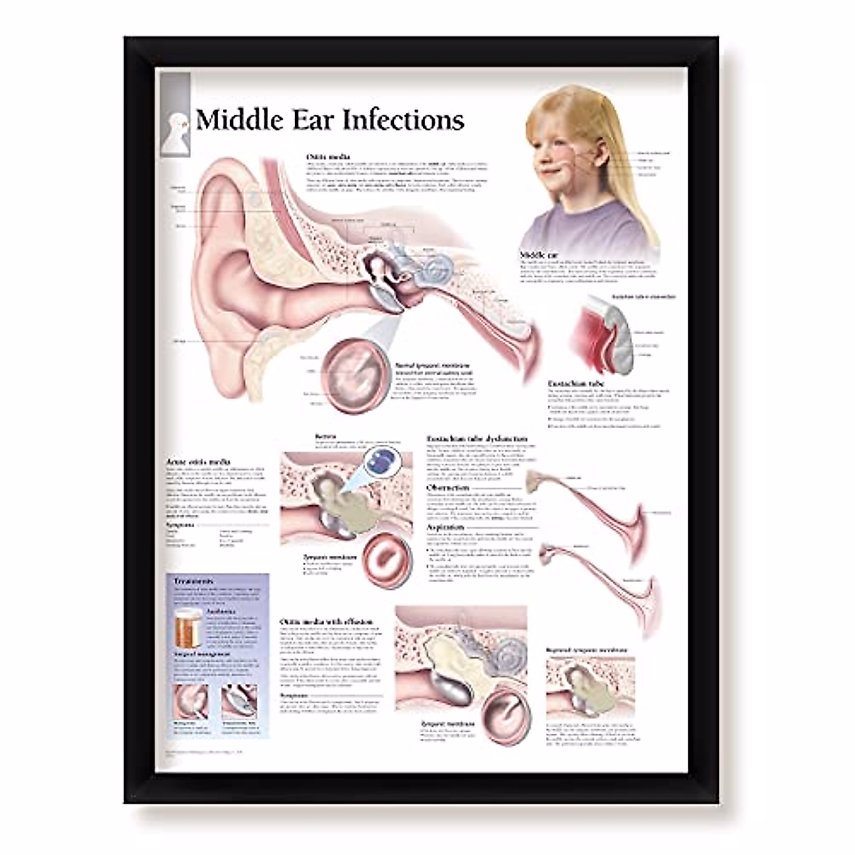 Set of 4 Framed Medical Posters Ear, Nose and Throat, Understanding Sinusitis, Understanding Rhinitis, and Middle Ear Infections 22"x28" Wall Diagrams