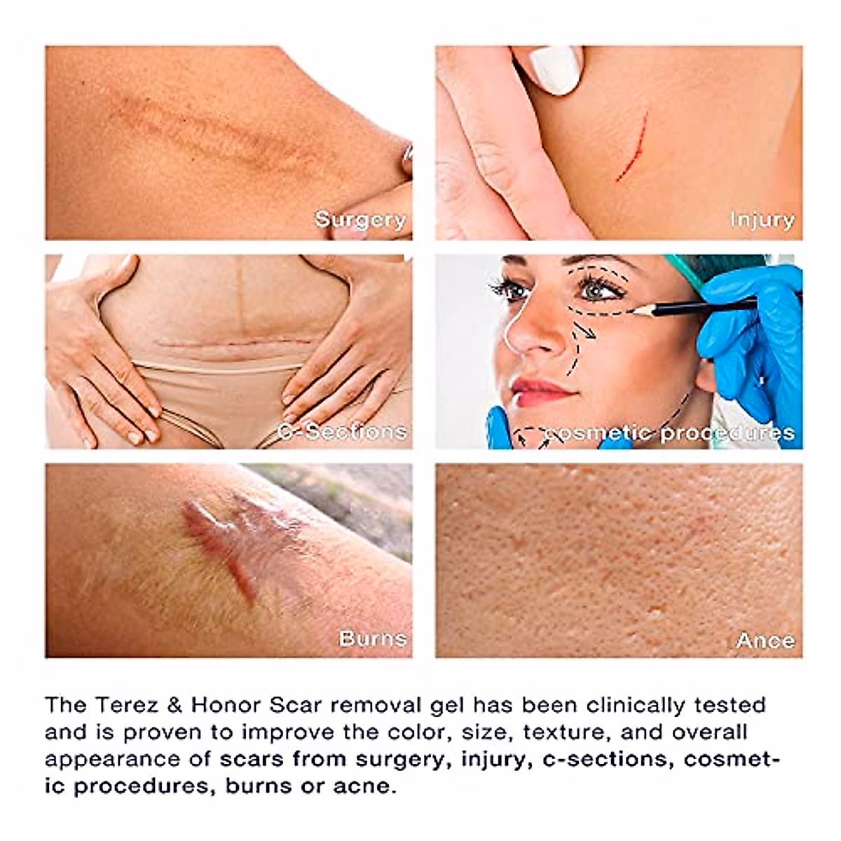 Scar Cream Gel, Advanced Silicone Scar Gel for Surgical Scars, C-Section, Stretch Marks, Acne, Surgery, Surgical Effective Treatment, Old and New Scars Management - 30g