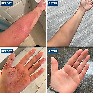 Grahams Natural C+ Eczema Relief Cream - Nourishes & Soothes Dermatitis, Inflammation, Redness Treatment for Irritated, Dry Skin - All Natural Ingredients with Manuka honey, Steroid-Free (1 x 1.76oz)