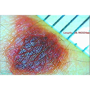 Firefly DE350 Wireless Polarizing Dermatoscope