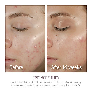 Epionce Lytic Tx - Moderate-Strength Product for Normal to Combination Skin with Salicylic Acid, Hyaluronic Acid & Azelaic Acid, Dermatologist Skincare