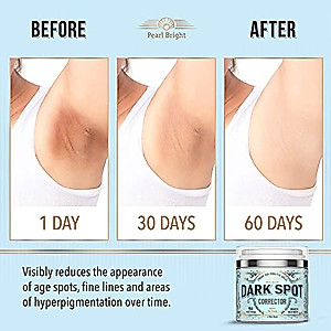 PearlBright Dark Spot Remover for Face, Body and Sensitive Areas - Natural Skincare for Underarms, Elbows & Privates - Made in USA - Dark Spot Corrector with Licorice, Mulberry Extract Arbutin, 1.7OZ