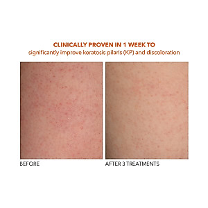 Dr Dennis Gross Alpha Beta Exfoliating Body Treatment | Multi-Tasking Powered by AHA/BHAs for Smooth, Hydrated Skin While Improving Ingrown Hairs, Keratosis Pilaris, and Blemishes | 8 Textured Towels