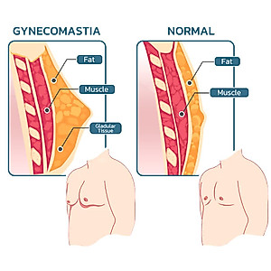 Cgtfy Gynecomastia Compress Tank Top For Men Slimming Body Shaper Vest Chest Abdomen Compression Tank Top (Blue,XXL/3XL)