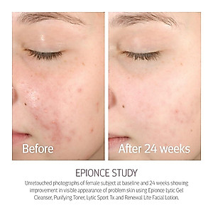 Epionce Renewal Lite Facial Lotion - Lightweight Hydrating, Anti-Aging Moisturizer for Combination to Oily & Problem Skin, Dermatologist Skincare