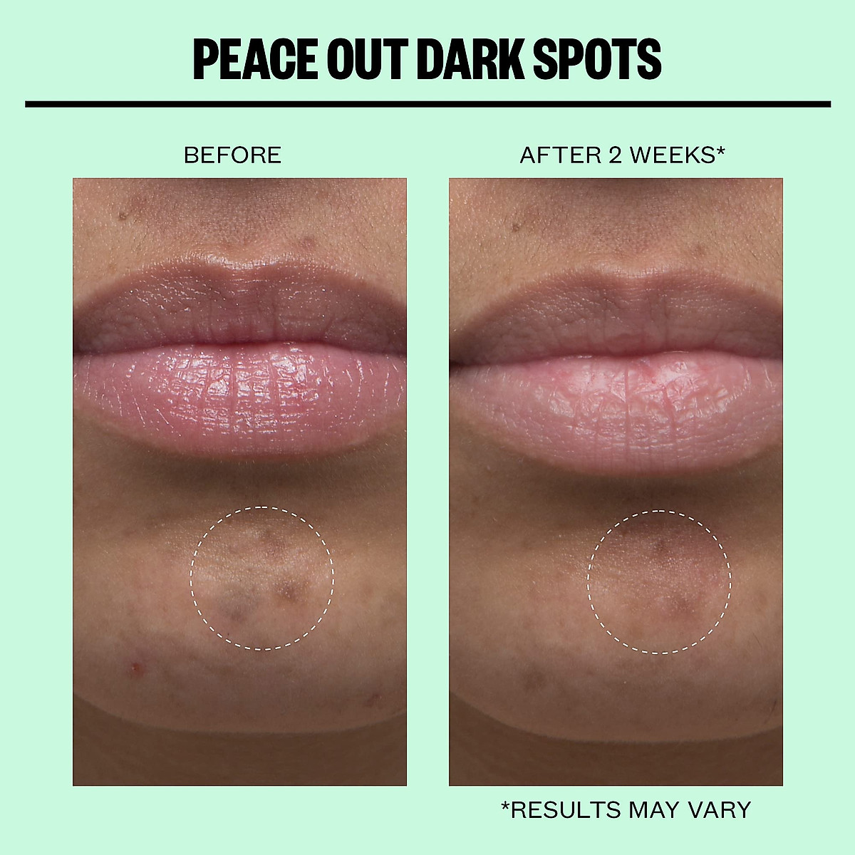 Peace Out Skincare Dark Spots. Dissolving Microstructure Dots to Reduce the Appearance of Dark Spots & Hyperpigmentation, Niacinamide Helps Reveal Clear, Even Skin (12 dots)