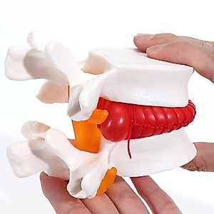 ASINTOD Human Anatomy Lumbar Disc Herniation Model,A Model Showing The Anatomy of Human Lumbar Disc, An Excellent Choice for Teaching and Learning The Human Lumbar Spine