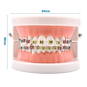 Angzhili 1 Piece Dental Demonstration Orthodontic Model with Metal Wires and Bracket (Metal bracket)