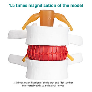 LVCHEN Disc Herniation Model - Human Lumbar Disc Herniation Spine Model 1.5X Intervertebral Disc Model Anatomical Vertebrae Disc Model with Elastic Software