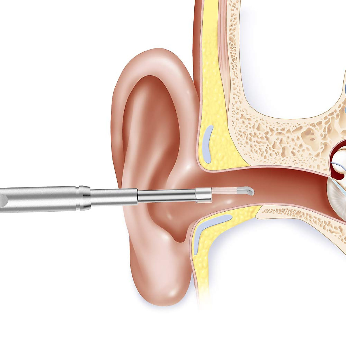 Teslong Otoscope Accessories: 9 Disposable Speculums, 4 Ear Picks, 1 Pack of Q-Tips, Accessories for NTE100i Ear Camera Ear Scope, 0.16 inch or 4.3mm Dia.