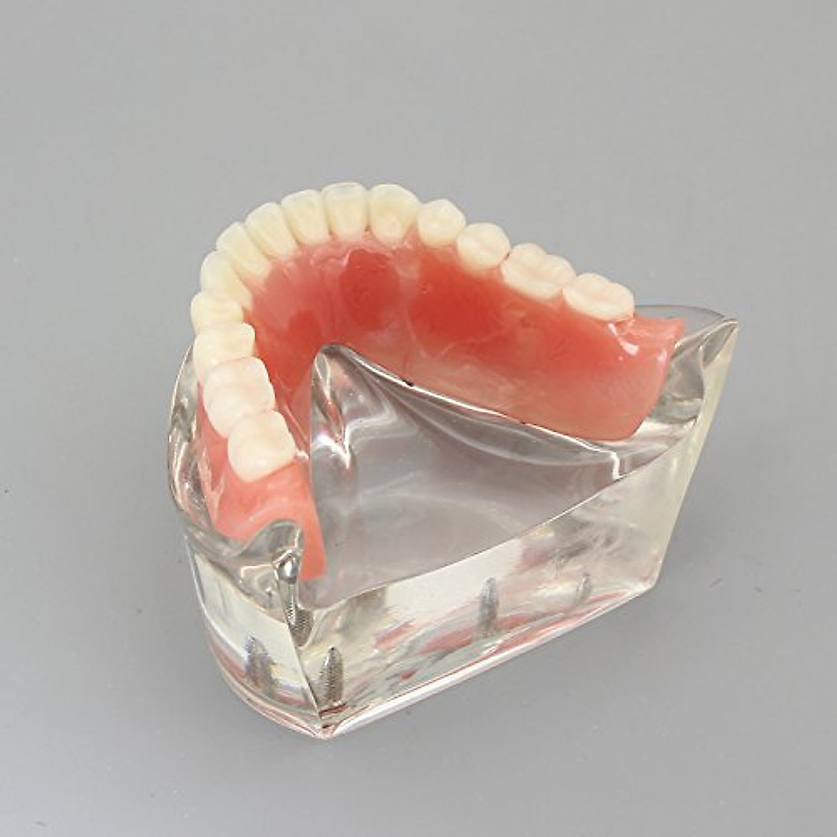 Smile1000 Dental Model Overdenture Inferior 4 Implants Demo for Teaching and Studying