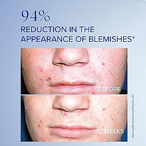 iS CLINICAL Active Serum; Face Serum, Anti-Aging, Helps skin with acne and pigmentation, 0.5 Fl Oz