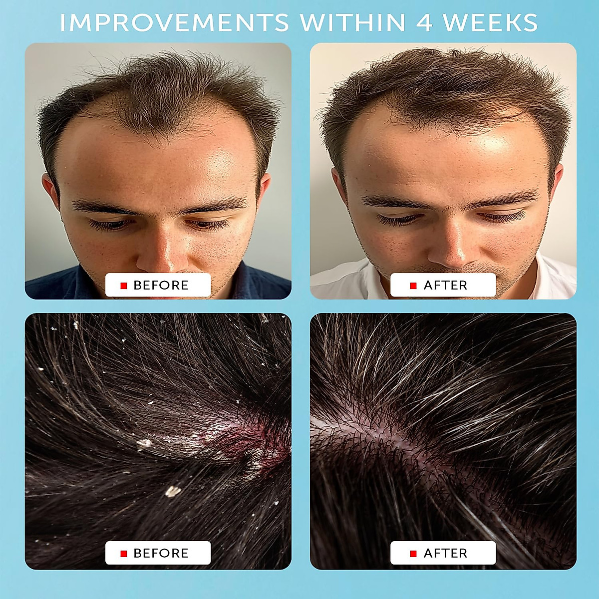 Sent From Earth Caffeine & Saw Palmetto Ketoconazole Biotin dandruff Treatment: Antifungal for Psoriasis, Folliculitis, Dermatitis, Dry Itchy Scalp Vegan Advanced Natural Formula Peppermint Shampoo