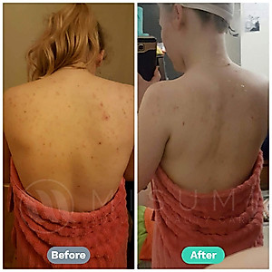 Misumi Acne Body Wash 120ml (4oz) - Keratosis Pilaris Treatment, Body & Back Acne Treatment - Salicylic Acid, Glycolic Acid AHA Body Wash for Men & Women Bacne