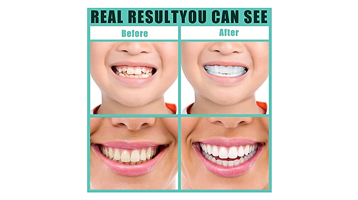 Fake Teeth Veneers - Instant Confidence & Smile Enhancement