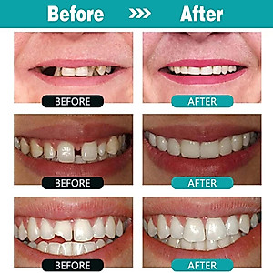 Ganbaro Moldable False Teeth, Teeth Repair Kit, Tooth Repair Granules, Temp Tooth Beads with 4 Dental Tools, Snap On Instant and Confident Smile