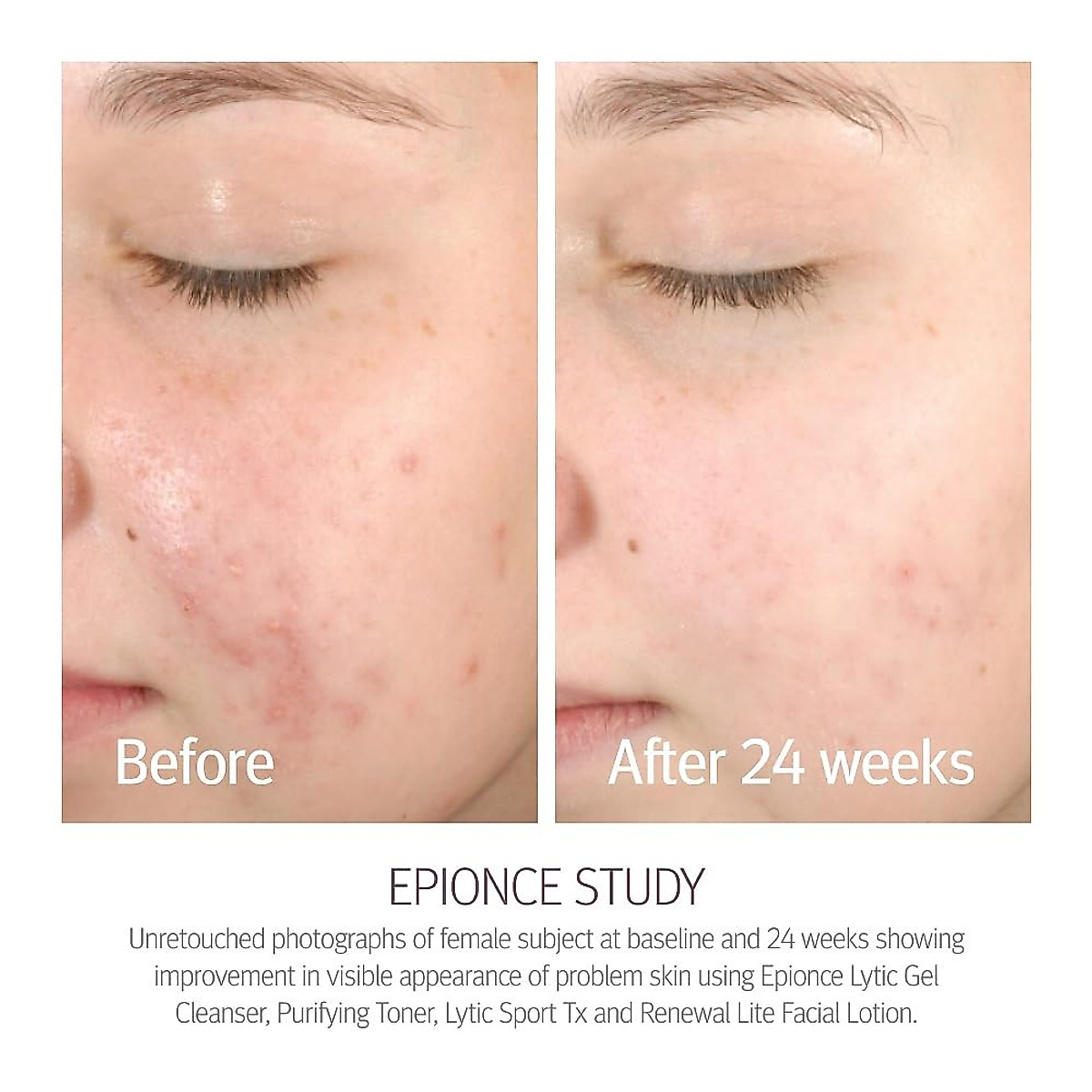 Epionce Renewal Lite Facial Lotion - Lightweight Hydrating, Anti-Aging Moisturizer for Combination to Oily & Problem Skin, Dermatologist Skincare