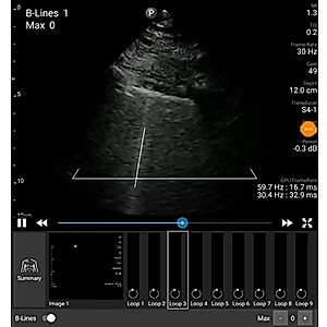 Philips Lumify S4-1 Phased Array Transducer, Portable Ultrasound Solution