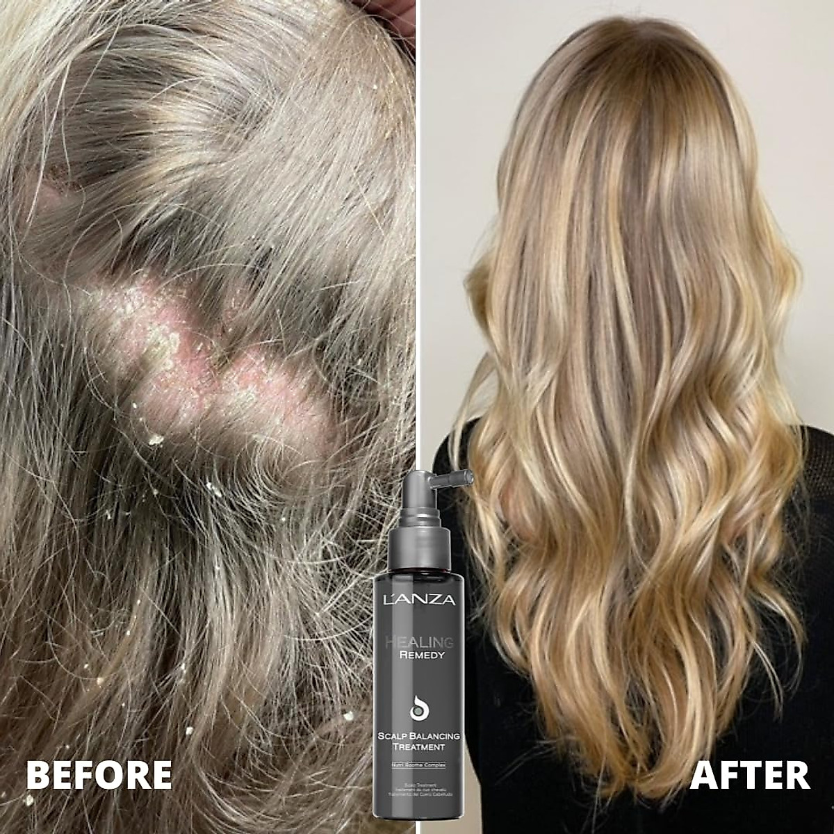 L'ANZA Healing Remedy Scalp Balancing Leave-in Treatment, Restores, Revives, and Nourish Hair & Scalp, Promotes Healthier Hair Growth, Thickness and Density (3.4 Fl Oz)