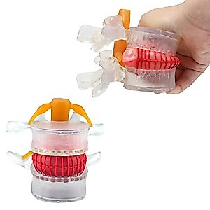 DenFactory Human 1.5 Times Life-Size Transparent Lumbar Disc Herniation Spine Model for Teaching and Learning