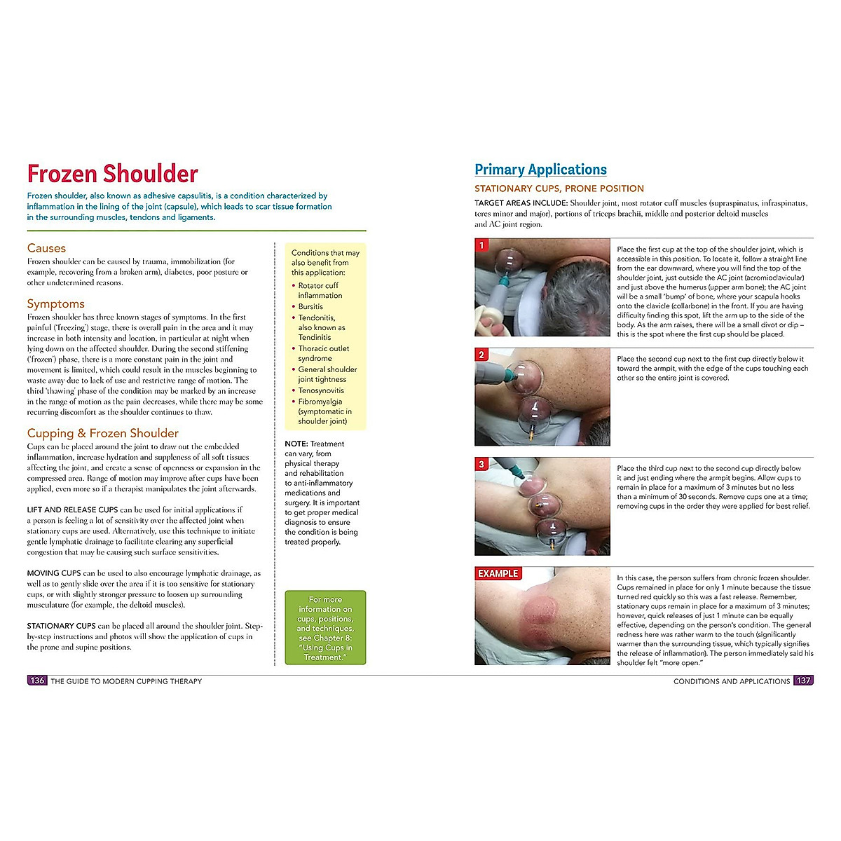 The Guide to Modern Cupping Therapy: Your Step-by-Step Source for Vacuum Therapy [Spiral-bound] Shannon Gilmartin