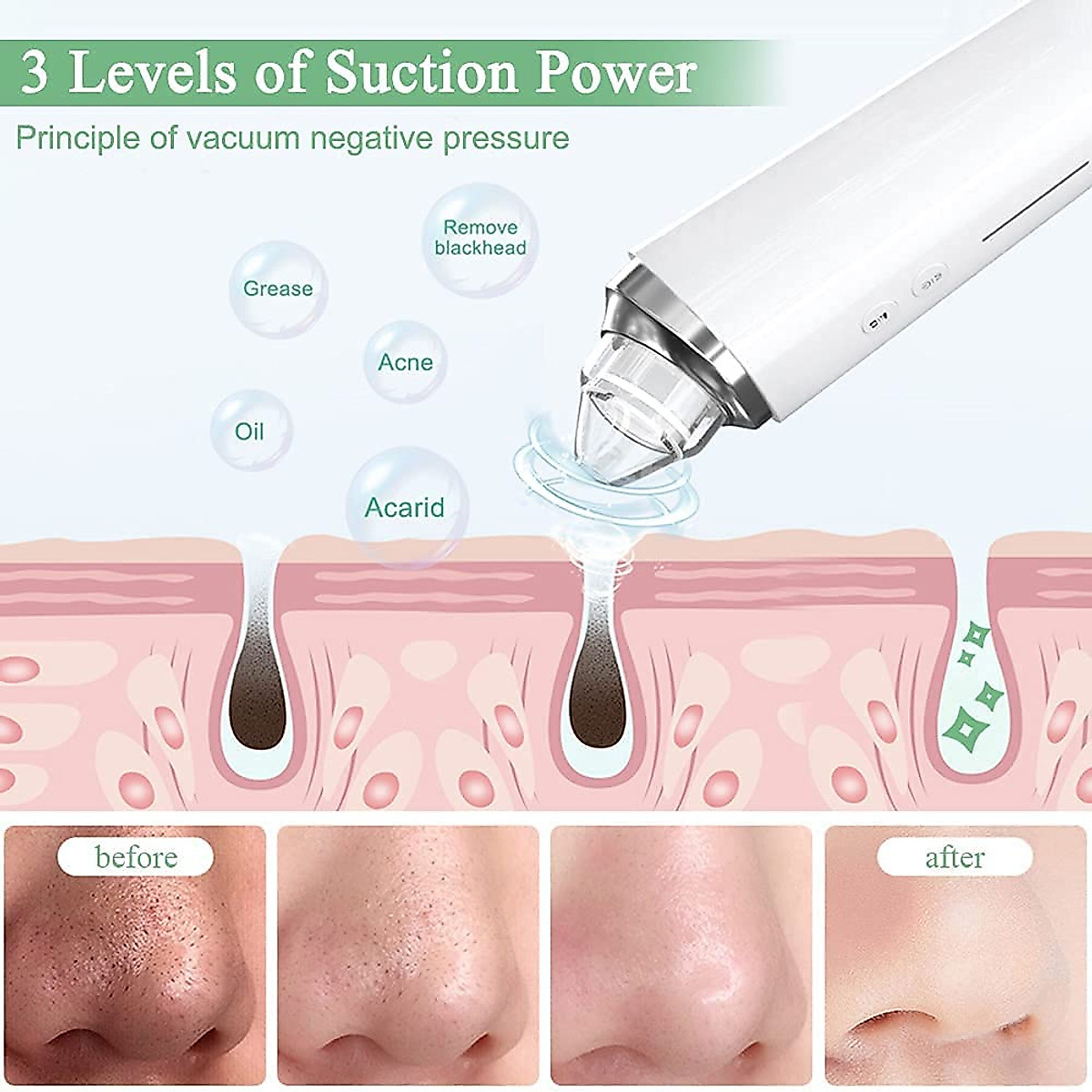 Blackhead Remover Pore Vacuum, 【[FDA Certification] 】WiFi Visible Facial Pore Cleanser with HD Camera Pimple Acne Comedone Extractor Kit with 6 Suction Heads Electric Blackhead Suction Tool