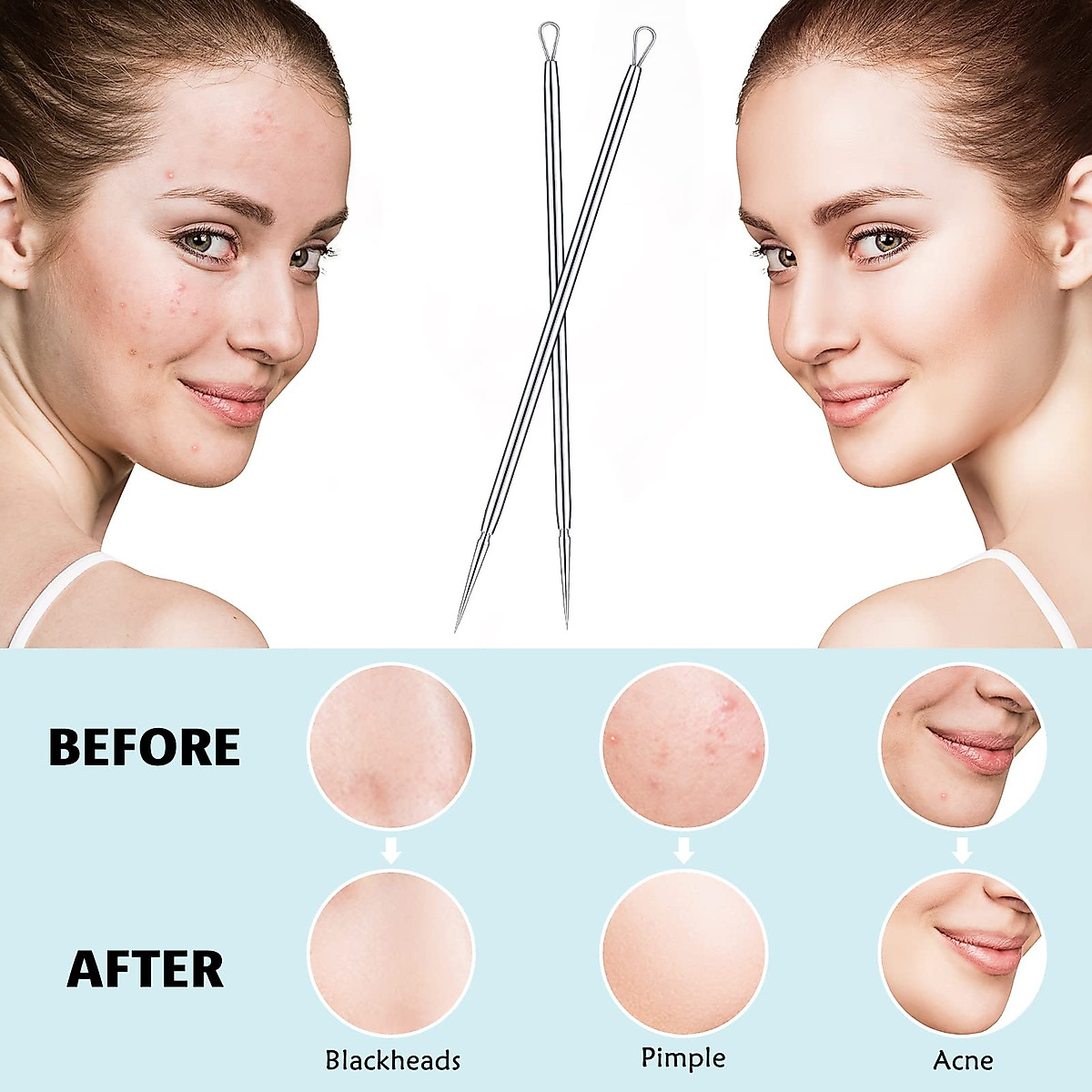 Titanium Lancet Needle Pimple Popper Tool Facial Milia Remover Blackhead Blemish Remover Blackhead Whitehead Extractor Professional Lancet Zit Blemish Comedone Removal Tool 2 Pieces with Box