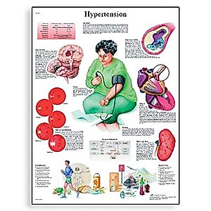 3B Scientific VR1361L Glossy Laminated Paper Hypertension Anatomical Chart, Poster Size 20" Width x 26" Height