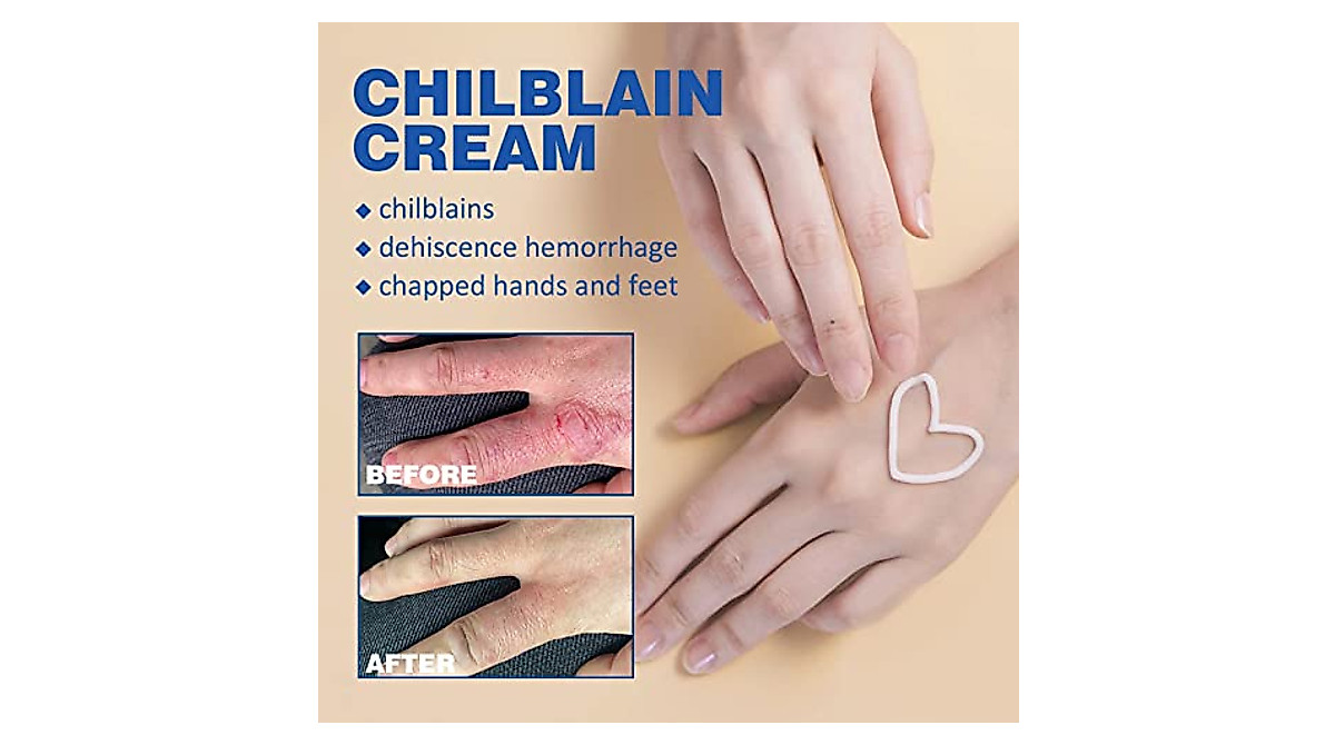 LONGLUAN Chilblain Cream - Deep Moisturizer for Cracked Skin