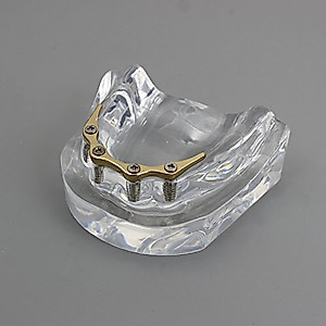 Dental Teeth Model Precision 4 Implant Overdenture Inferior Tooth Golden Color