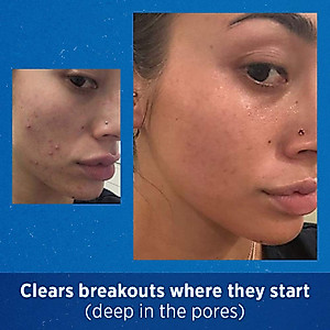 Differin Adapalene Prescription Strength Retinoid Gel 0.1% Acne Treatment (Up to 90 Day Supply), 45 Gram