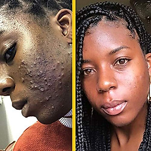 Pure Pigmentation Cream, Derm by Erica for Melasma