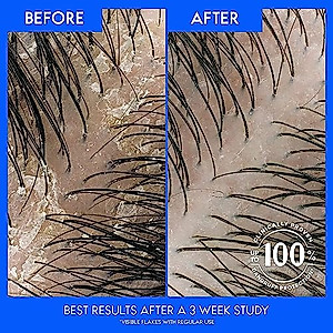 Head & Shoulders Dandruff Shampoo, Clinically Proven Anti Dandruff & Scalp Care Treatment, Fresh Green Apple Scent, Paraben-Free, 32.1 Fl Oz Each, 2 Pack