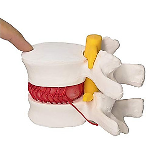 Realistic Herniated Disc Model for Medical Education