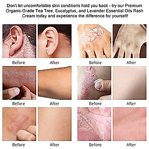 Eczema Psoriasis Manuka Relief Honey Cream, Hand Foot, Tinea Versicolor, Itchy Feet, Butt, Anal Itch, Scalp Dandruff, Bee Sting, Bites, Boil Cyst, Armpit, Adults Kids, Natural Organic Soothing