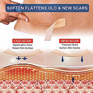 Silicone Scar Sheets (1.6” x 120” Roll-3M), Silicone Scar Tape Roll, Scar Silicone Strips, Reusable, Professional Scar Removal Sheets for C-Section, Surgery, Burn, Keloid, Acne et