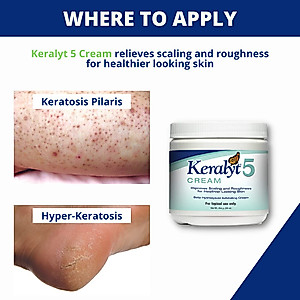 Keralyt 5 Psoriasis Cream - Full Body 5% Salicylic Acid Exfoliating Skin Lotion - Promotes Relief from Itchy, Redness, Dryness, Roughness, and Flakey Skin