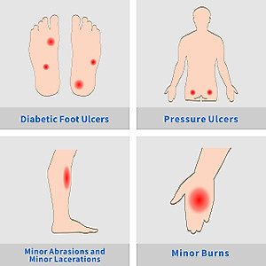 Algitocare Calcium Alginate Wound Dressing 2"x2" with 0.8"x12"