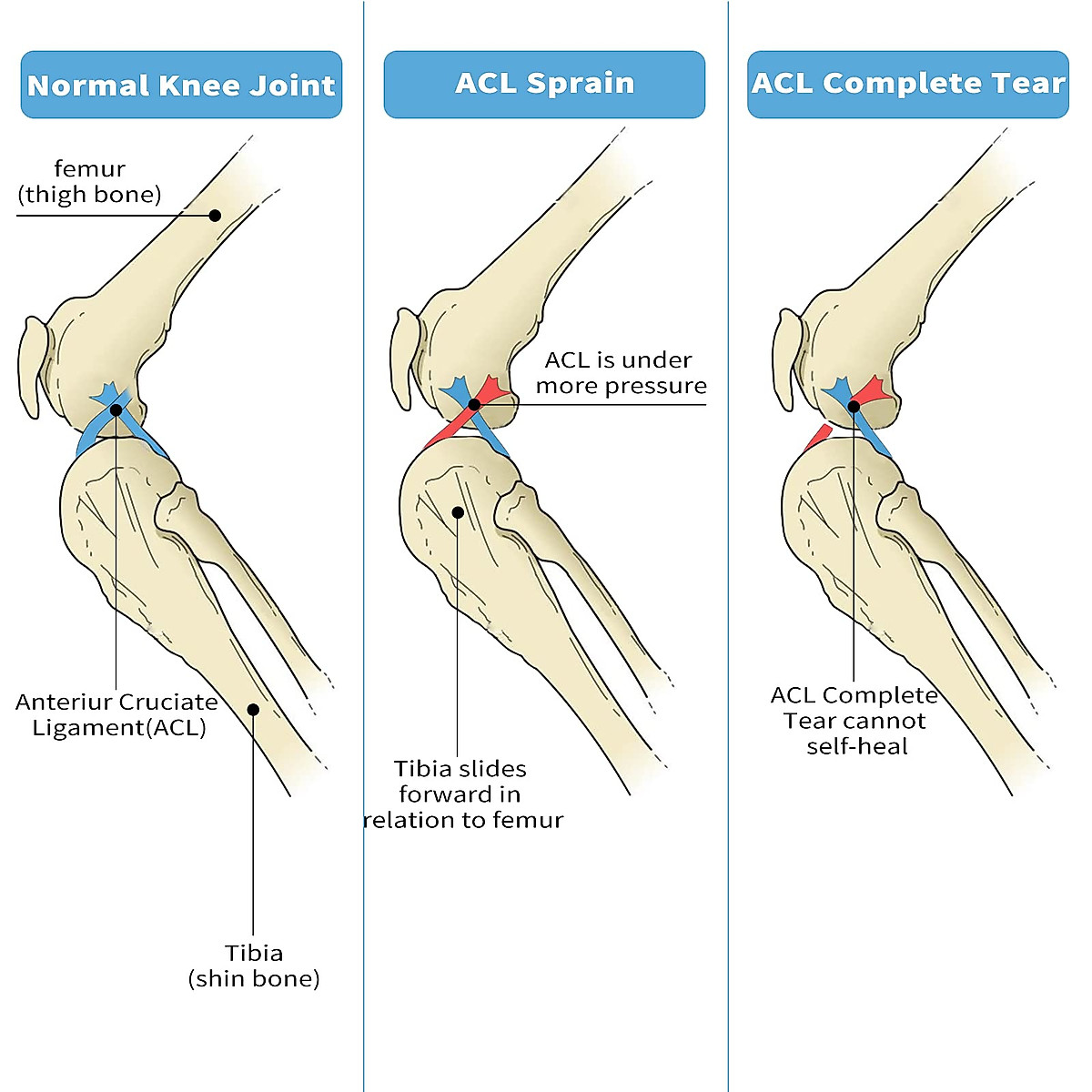 Noillow Dog Knee Brace, Dog Leg Brace for Sprain ACL, CCL, Arthritis - Keeps The Joint Warm and Stable, Leg Wounds Care and Prevent Licking, Dog Rear Leg Luxating Patella Brace-Right-L