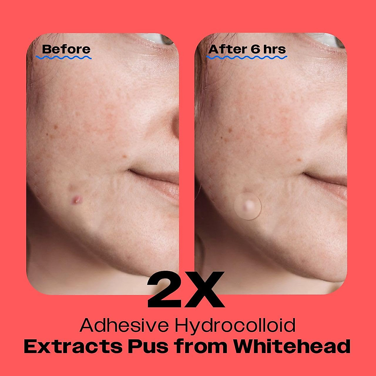 AVARELLE Pimple Patches Double Variety Duo Hydrocolloid Acne Patches, for Blemishes and Zit with Tea Tree Oil, Calendula Oil and Cica Oil for Face, Vegan, Cruelty Free (80 Count + Variety)